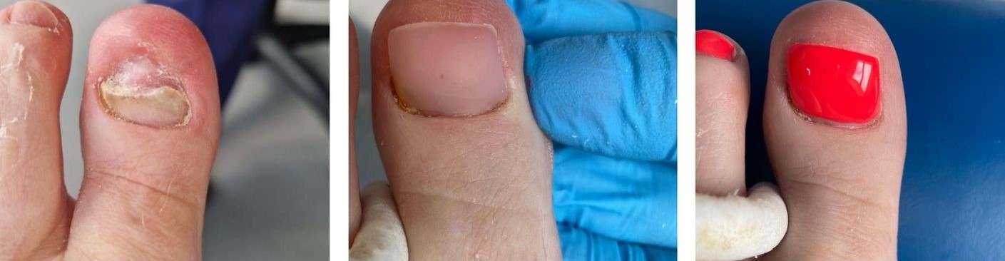 Toenail Reconstruction